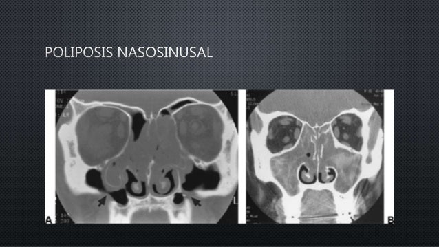 Radiología de nariz y senos paranasales