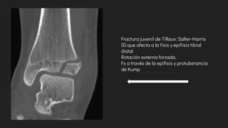 Radiologia: Fracturas mas comun en pediatría | PPT