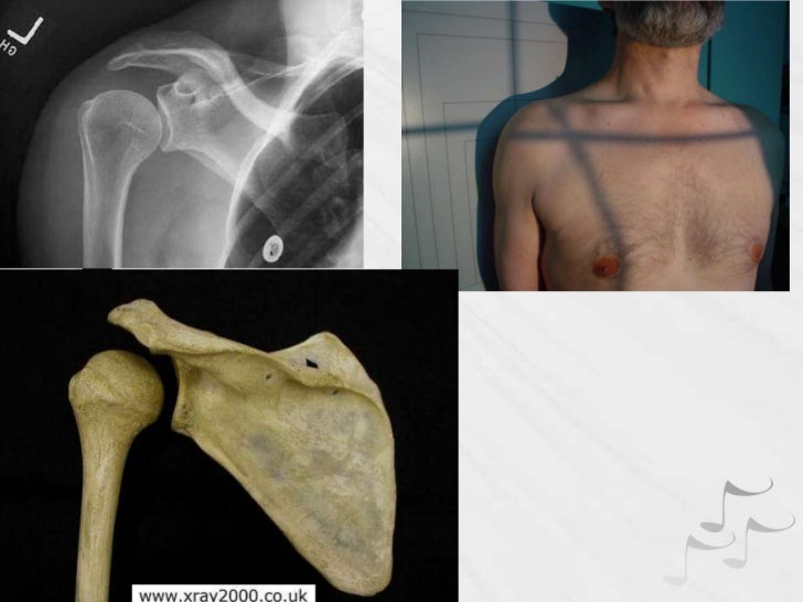 Radiología hombro