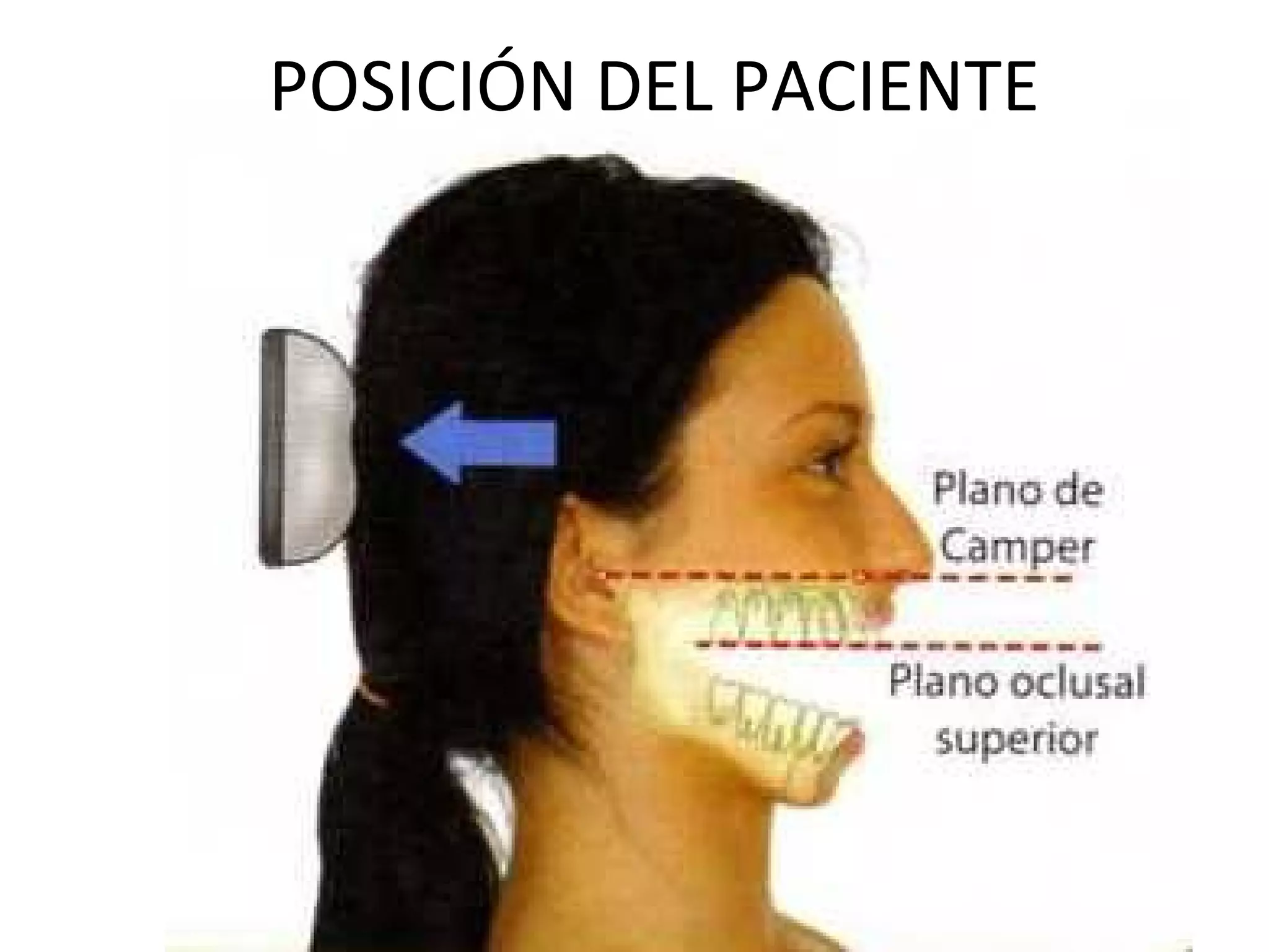 Tecnica de la bisectriz | PPT