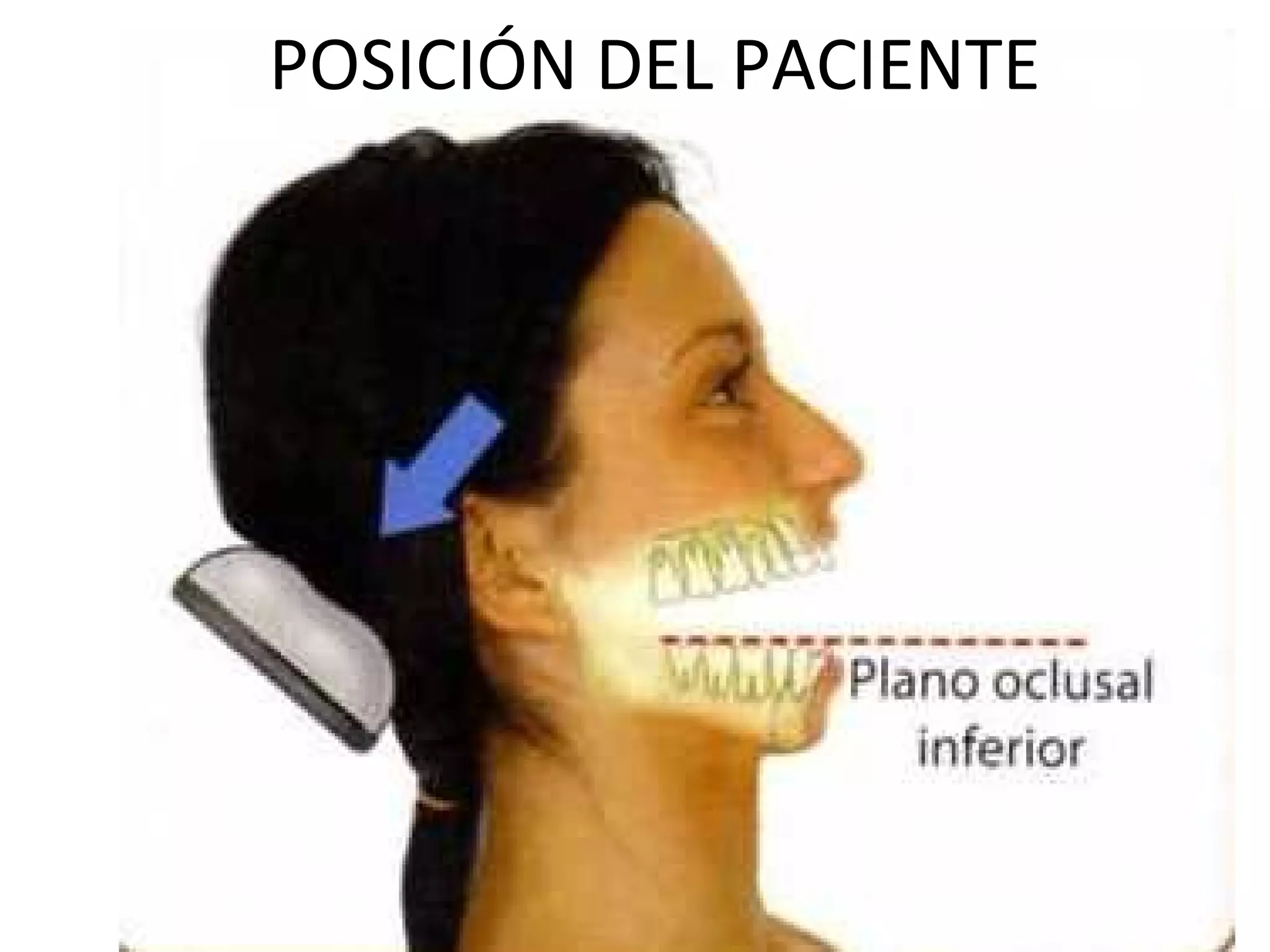 Tecnica de la bisectriz | PPT