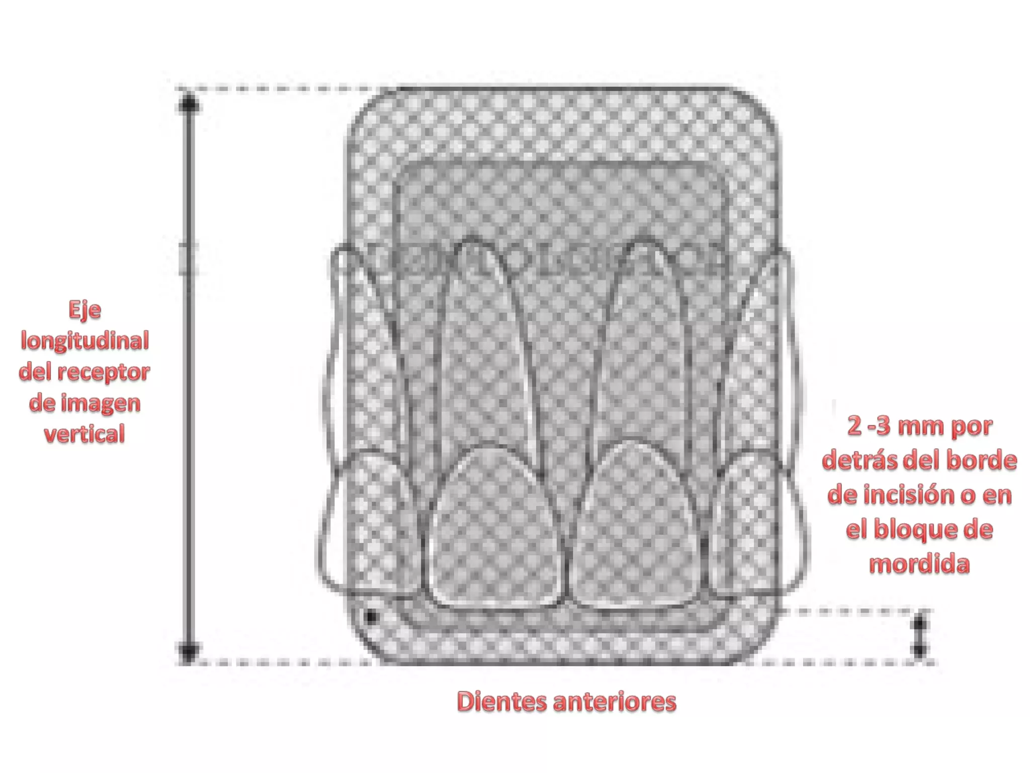 Tecnica de la bisectriz | PPT