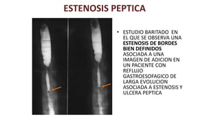 Radiologia de esofago y estomago | PPTX