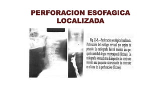 Radiologia de esofago y estomago | PPTX