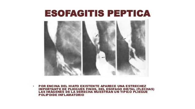 Radiologia de esofago y estomago