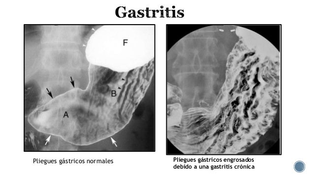Radiologia de esofago y estomago