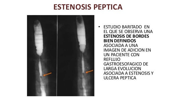 Radiologia de esofago y estomago