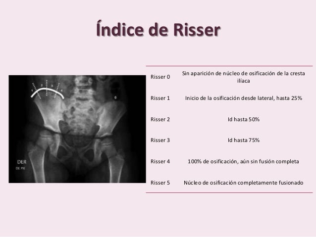 Radiología de la escoliosis