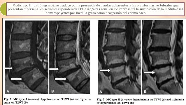 Radiologia de lesiones de columna