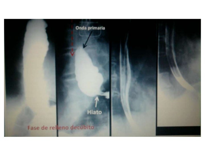 Radiologia del esofago