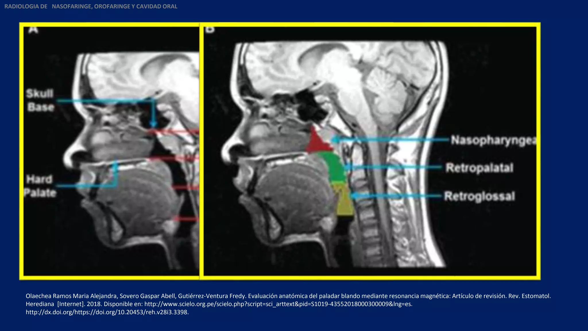RADIOLOGIA DE NASOFARINGE^J OROFARINGE Y CAVIDAD ORAL.pptx