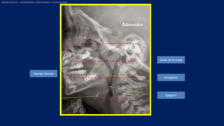 RADIOLOGIA DE NASOFARINGE^J OROFARINGE Y CAVIDAD ORAL.pptx