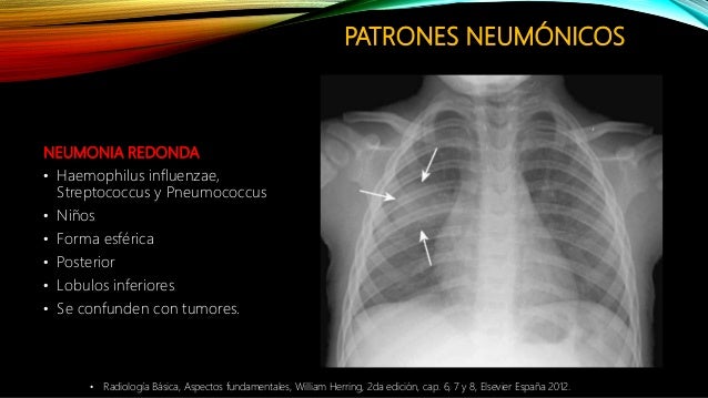 Radiologia, derrame pleural, neumonia y neumomediastino, Dr. Carlos A…