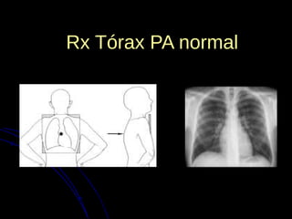 Radiologia de torax | PPT