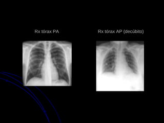 Radiologia de torax | PPT