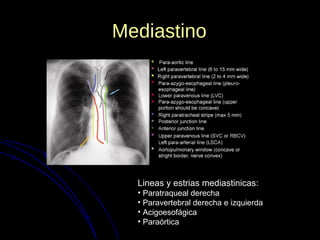 Radiologia de torax | PPT