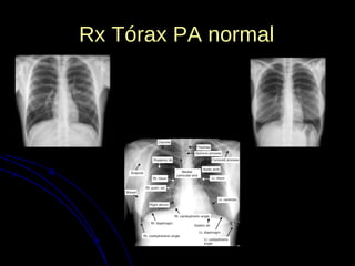 Radiologia de torax | PPT