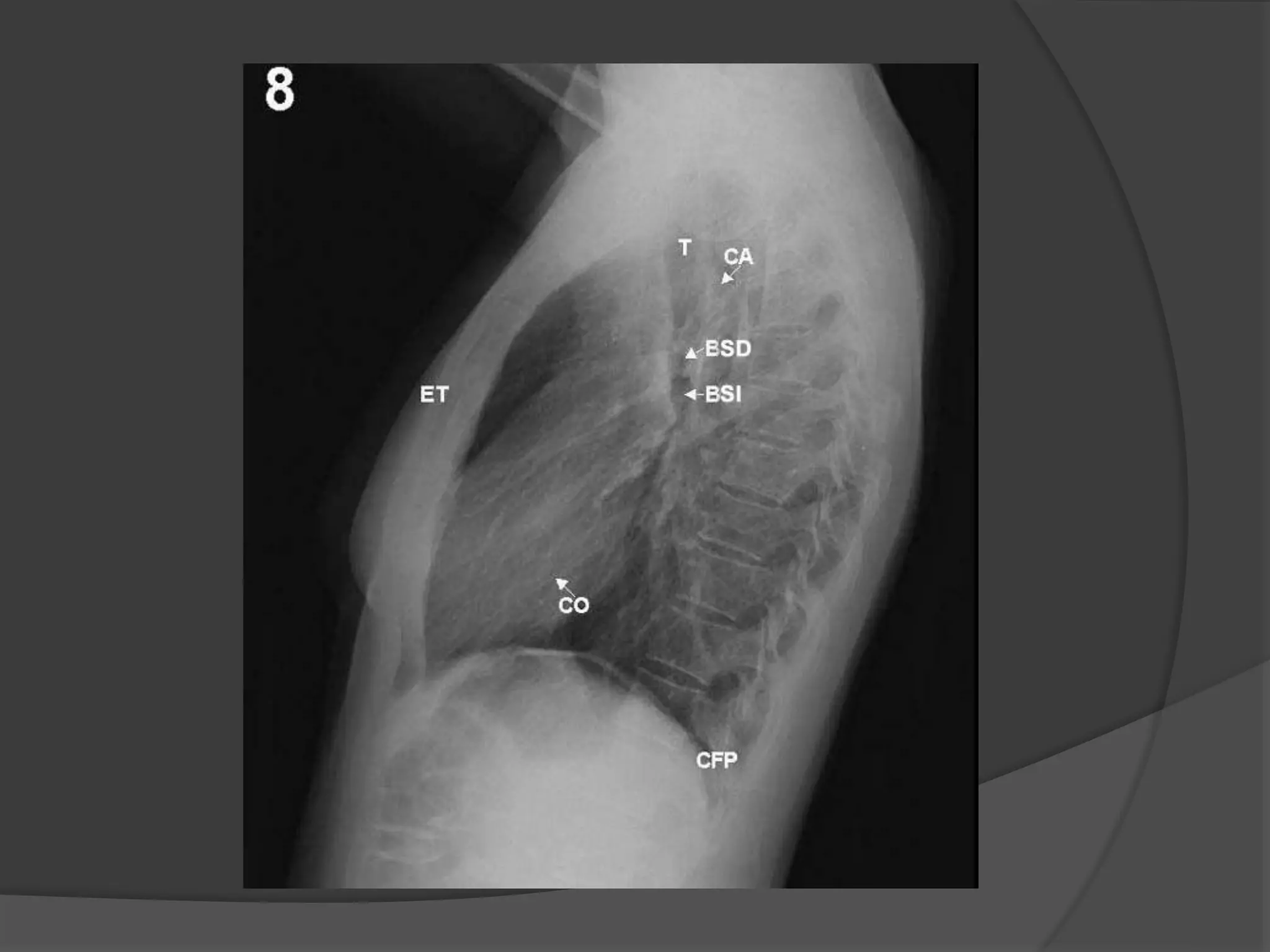 Radiologia De Torax Ppt