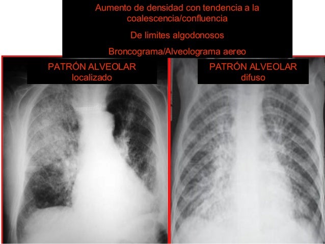 Radiologia del torax- semiologia