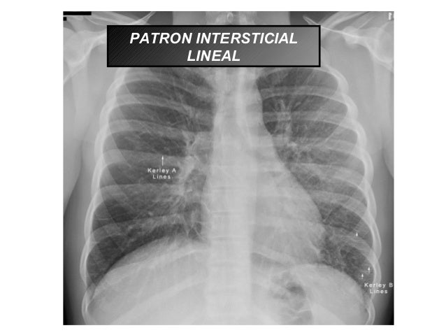 Radiologia del torax- semiologia