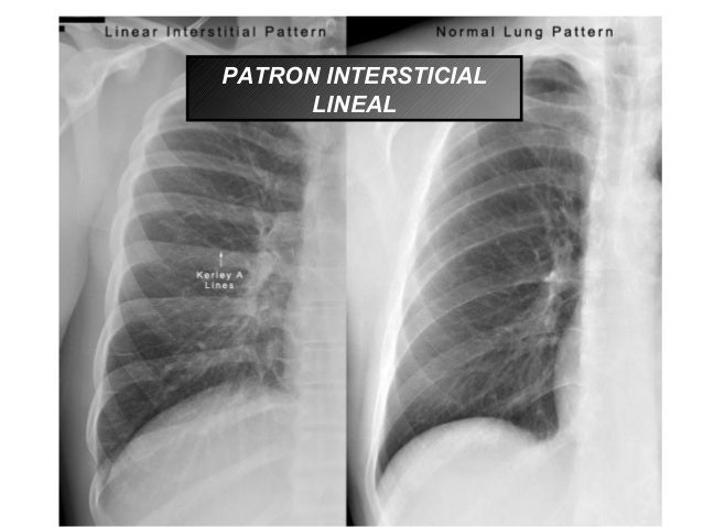 Radiologia del torax- semiologia