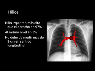 Radiologia de tórax neumo | PPTX
