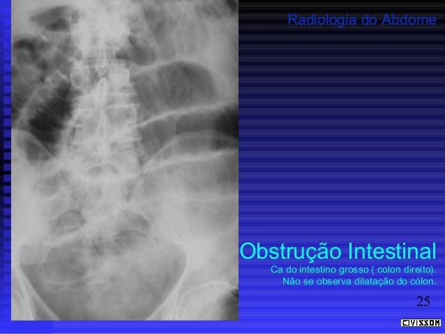 Radiologia do abdome