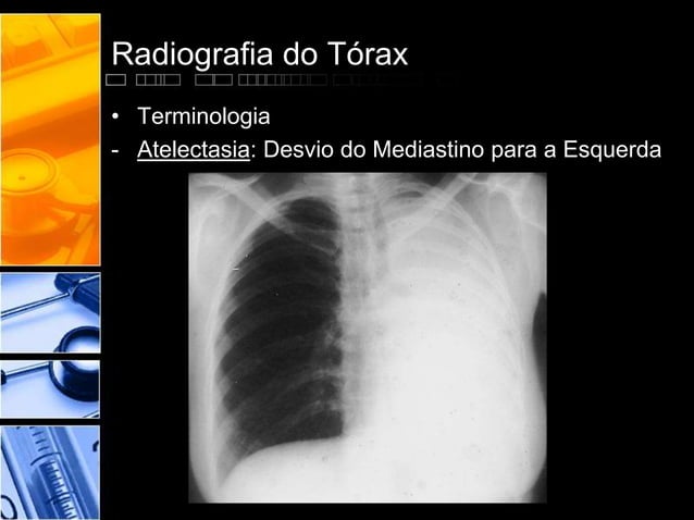 Radiologia do tórax | PPTX