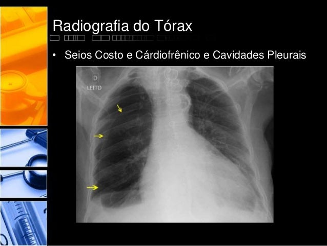 Radiologia do tórax