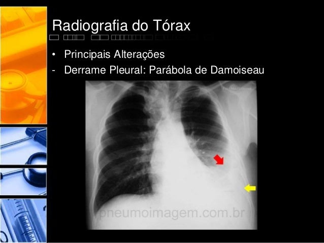 Radiologia do tórax