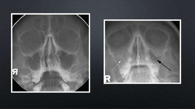 Radiologia e imagen de nariz y spn