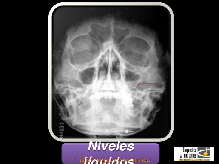 Radiologia infecciones. senos paranasales.