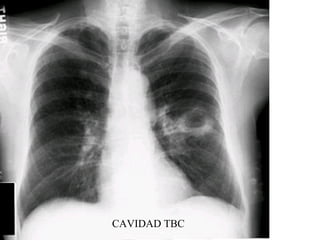 Radiologia toracica | PPT