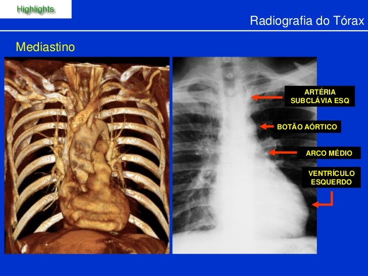 Radiologia torax