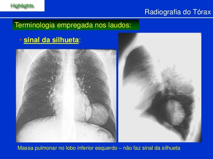 Radiologia torax