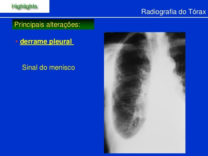 Radiologia torax