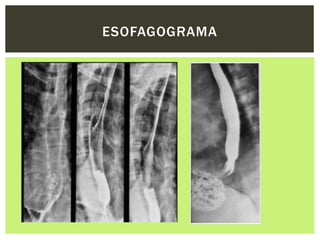 Radiología del Tubo Digestivo | PPTX
