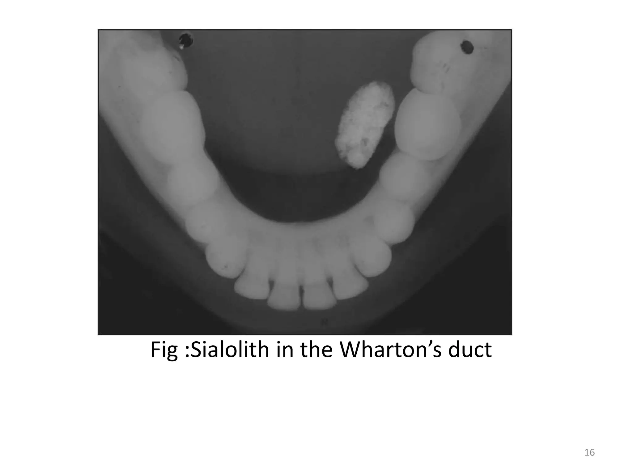 Radiology in oral & maxillofacial surgery | PPTX