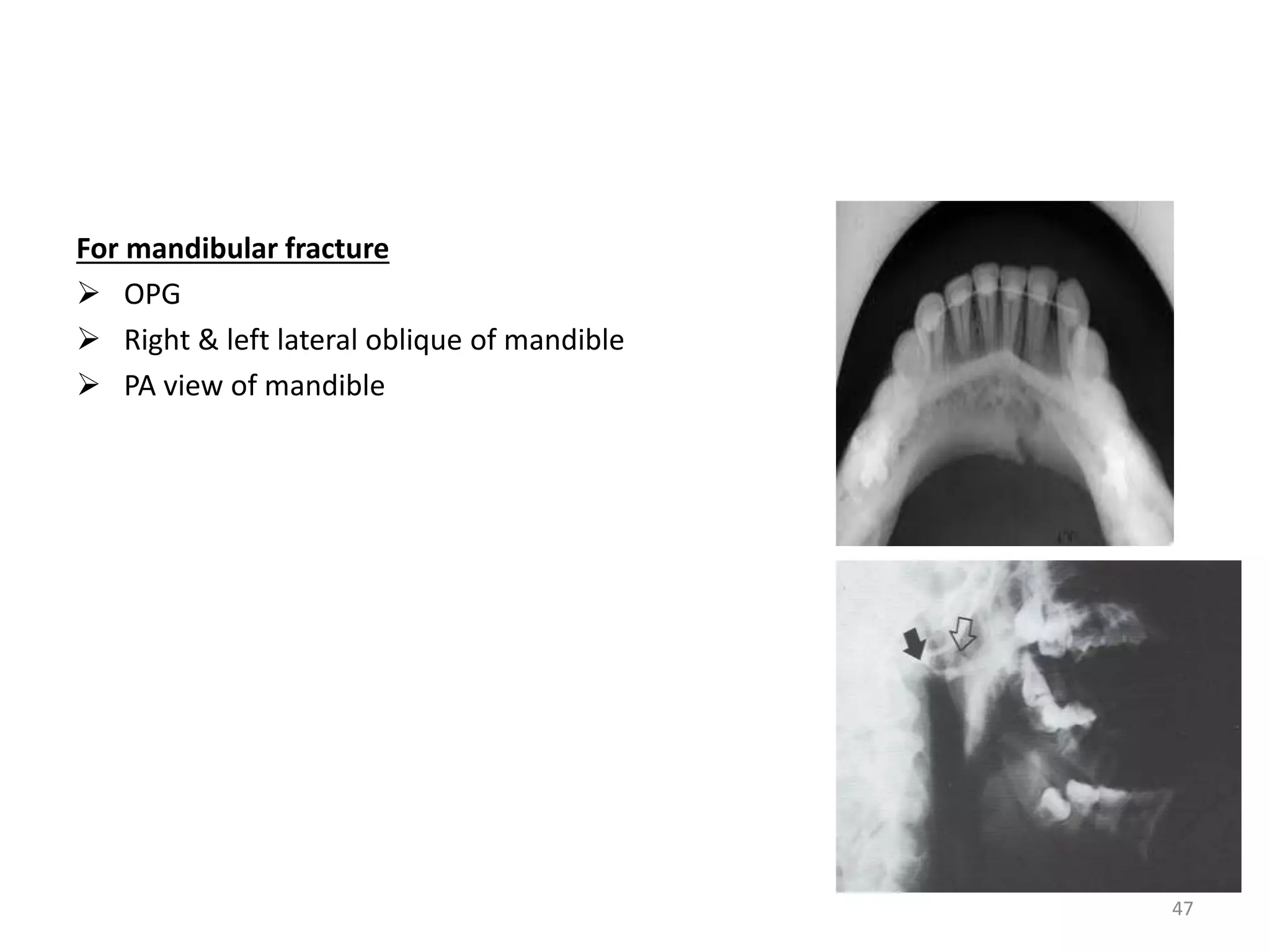 Radiology in oral & maxillofacial surgery | PPTX