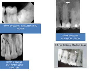 Radiology in oral & maxillofacial surgery | PPTX
