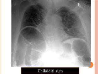 Radiological Anatomy for fracture...pptx