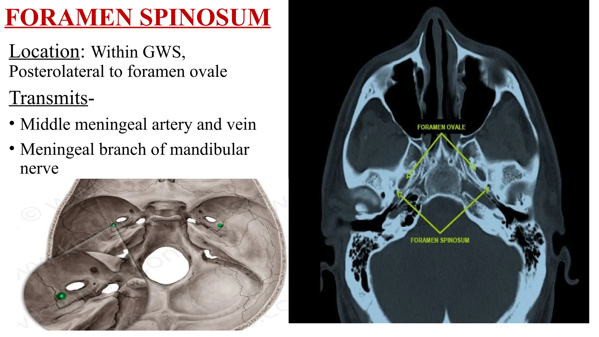 Radiological anatomy of base of the skull and craniovertevral junction ...