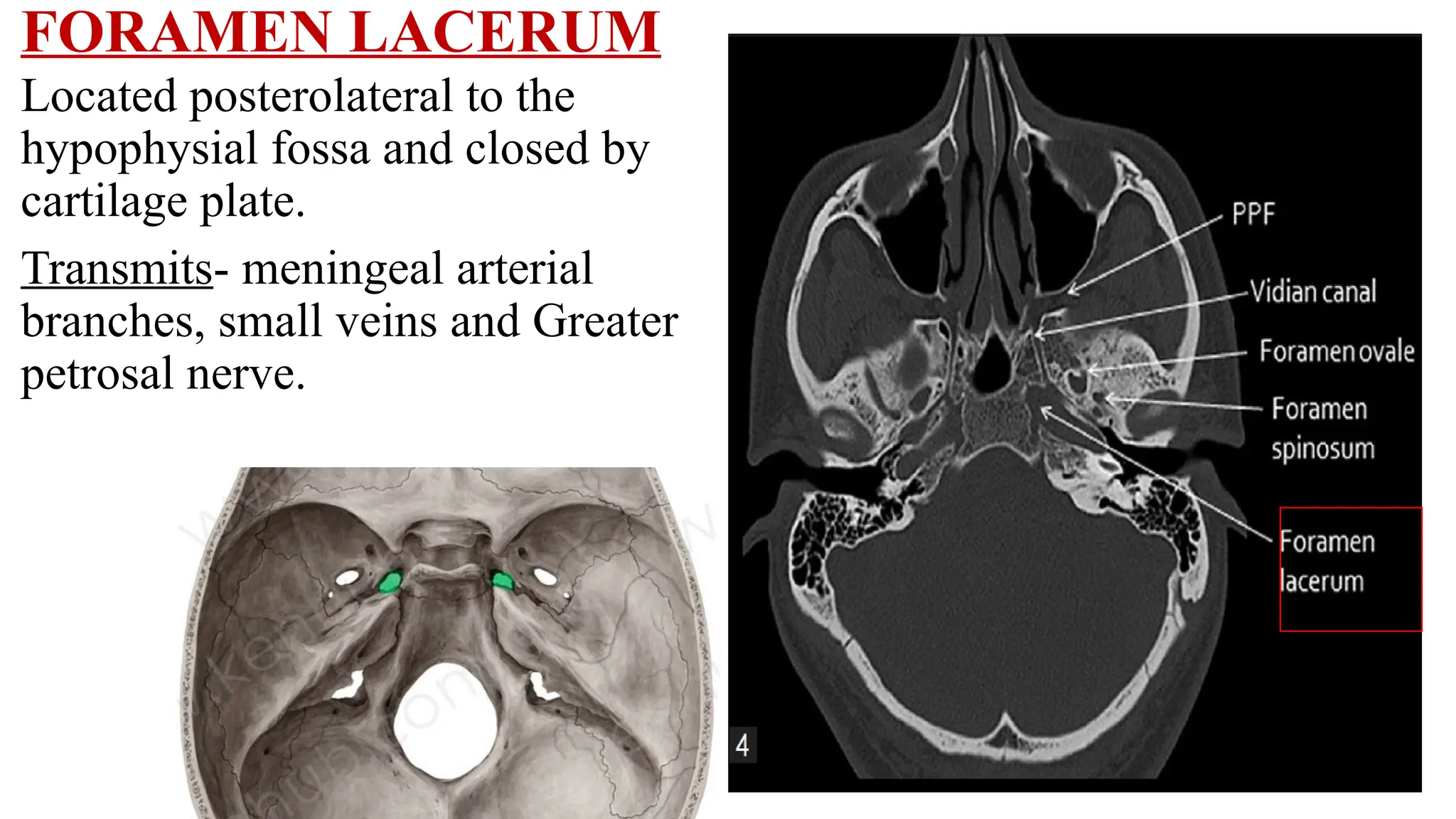 Radiological anatomy of base of the skull and craniovertevral junction ...
