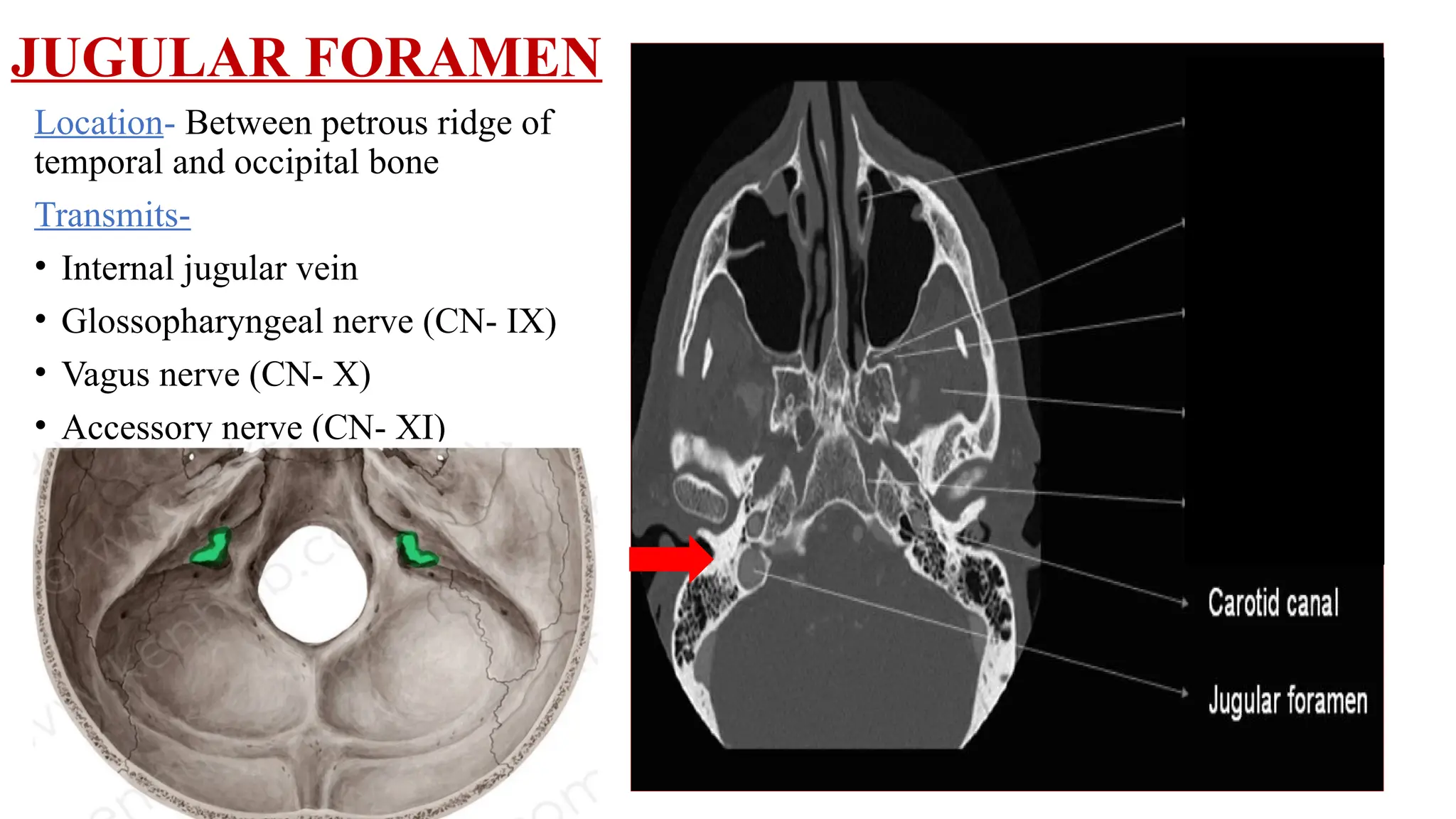 Radiological anatomy of base of the skull and craniovertevral junction ...
