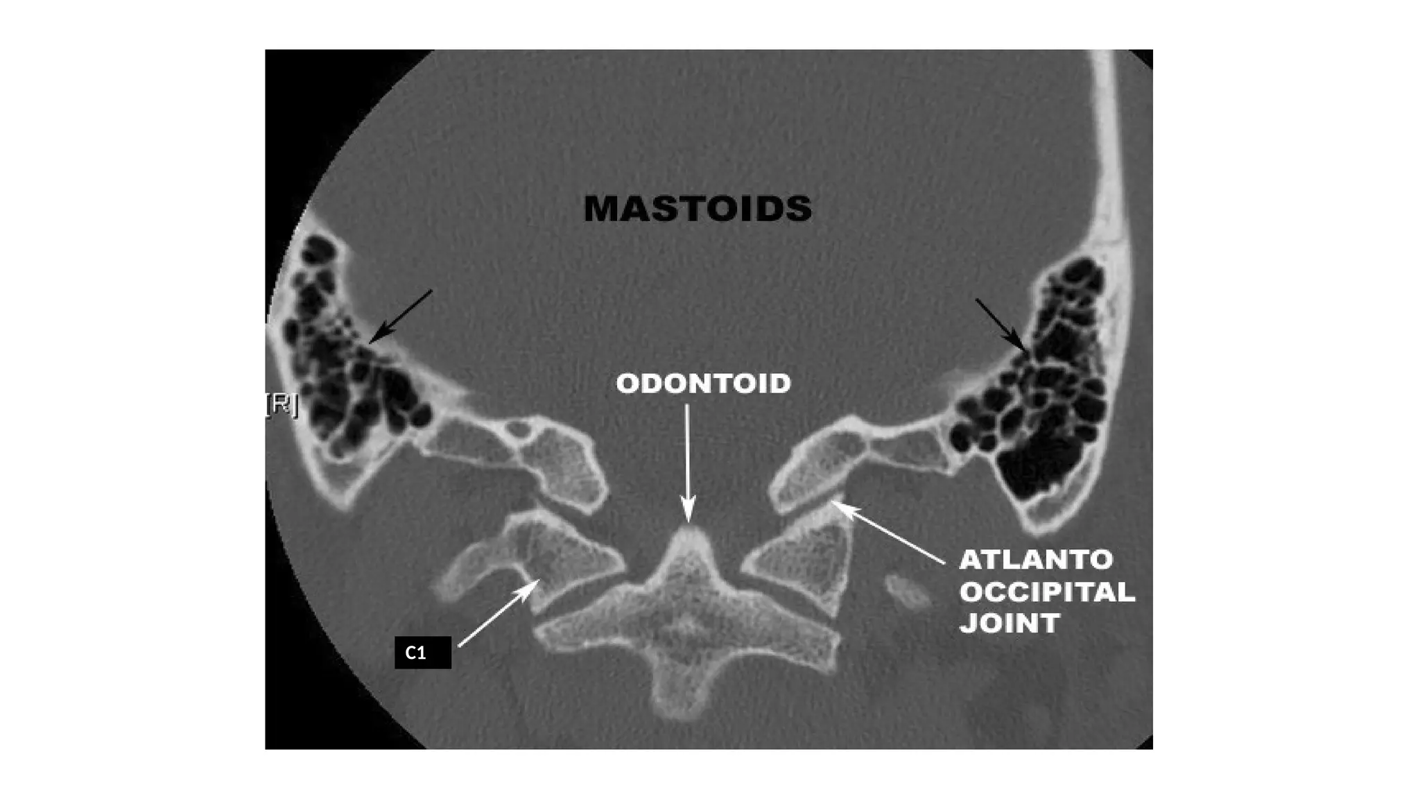 Radiological anatomy of base of the skull and craniovertevral junction ...