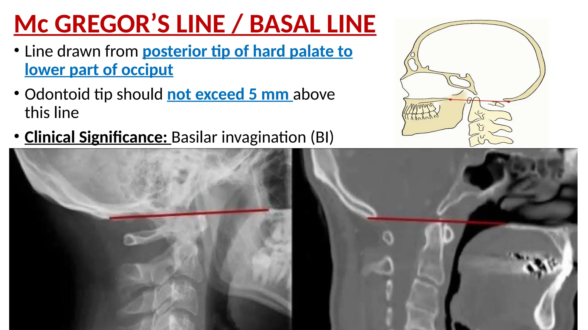 Radiological anatomy of base of the skull and craniovertevral junction ...