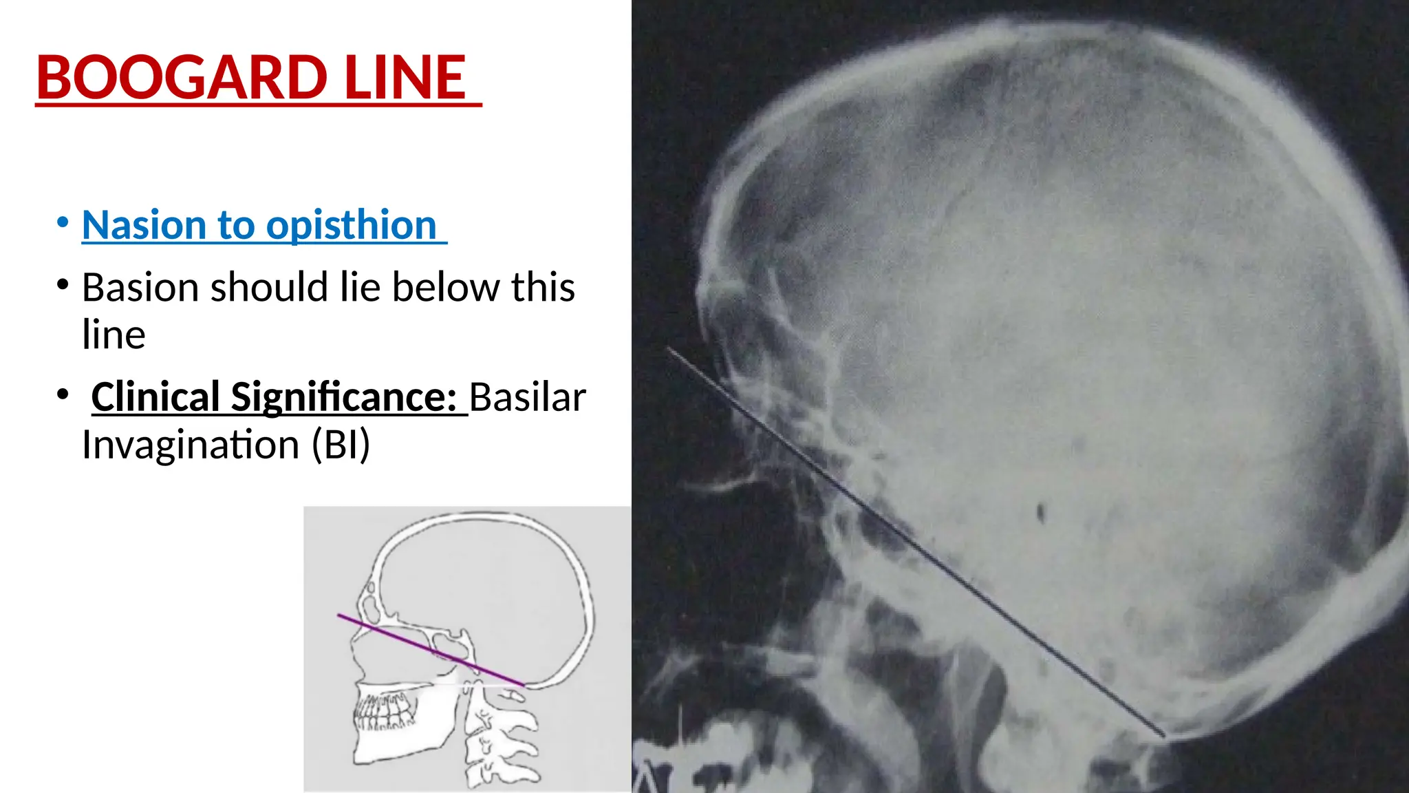 Radiological anatomy of base of the skull and craniovertevral junction ...