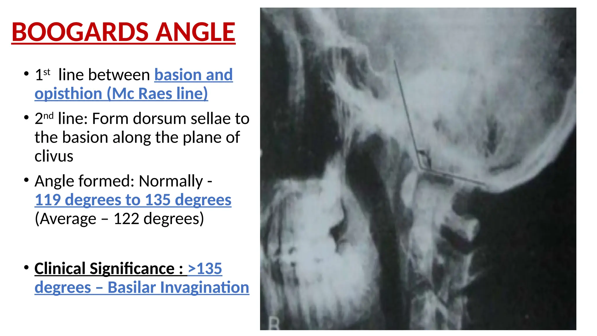 Radiological anatomy of base of the skull and craniovertevral junction ...