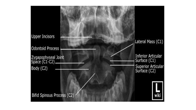 Radiological anatomy of base of the skull and craniovertevral junction ...