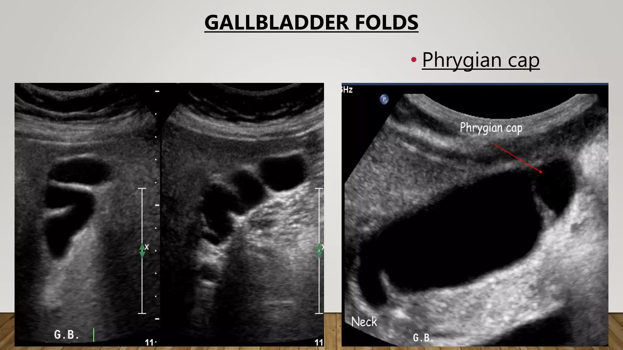 Radiological anatomy of biliary system | PPTX